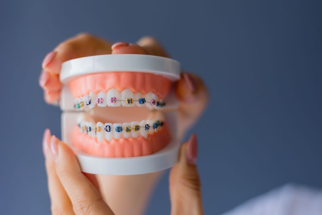 Different Braces Options at Davis & Goldberg Orthodontics