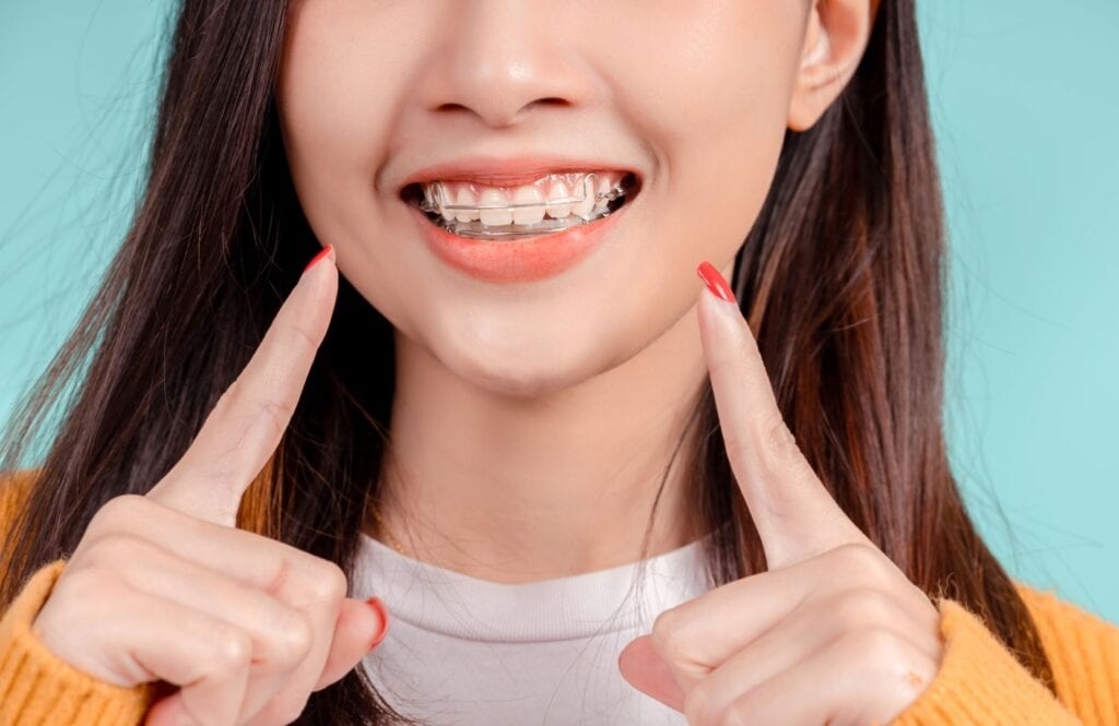 Everything You Should Know About Retainers